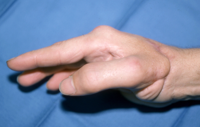 AMPUTATION, HAND | Hand Surgery Resource